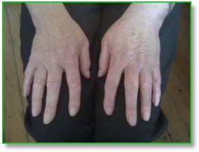 Fall / Bruised and cut hands — SCENAR-therapy