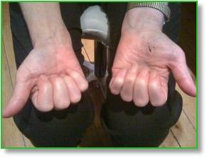 Fall / Bruised and cut hands — SCENAR-therapy